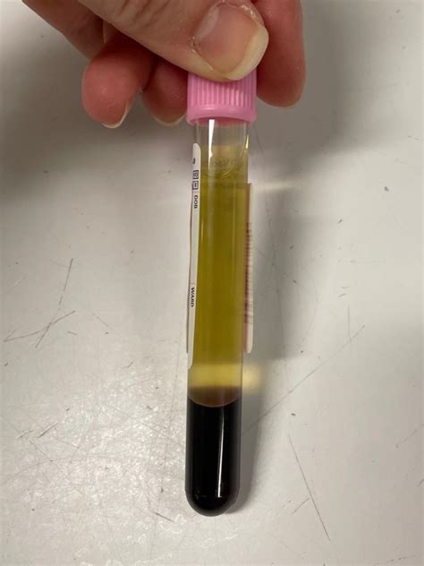 Red Blood Cells Hemolysis Professional Education