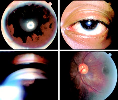 Iris Pigment Spot On