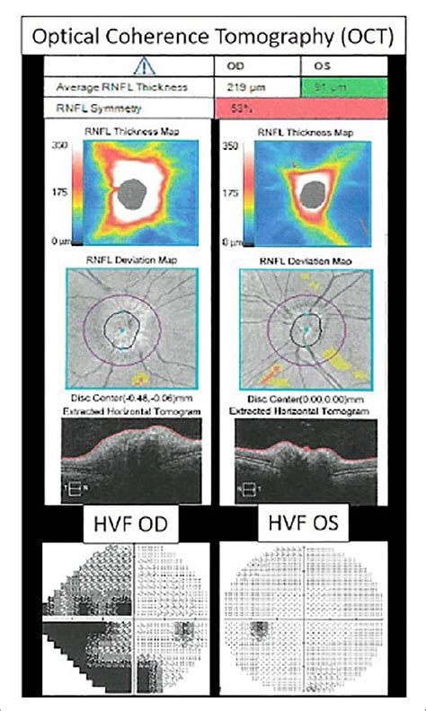 Initial Exam Optical Coherence Tomography Oct With Quantification Of