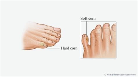 Corn Vs Callus Whats The Difference