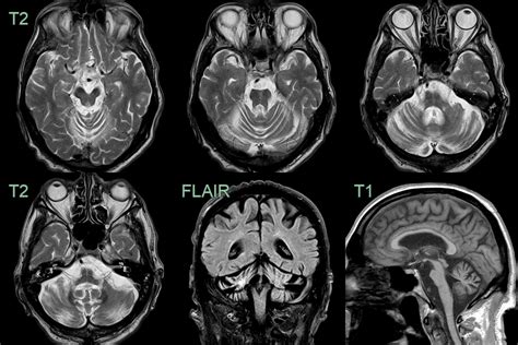 Multisystem Atrophy Cerebellar Type Msa C Neuroradiology