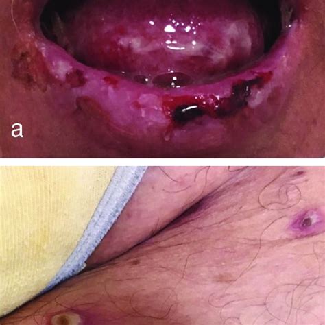 A Erosive Exudative Lesions On The Buccal Mucosa B Ruptured