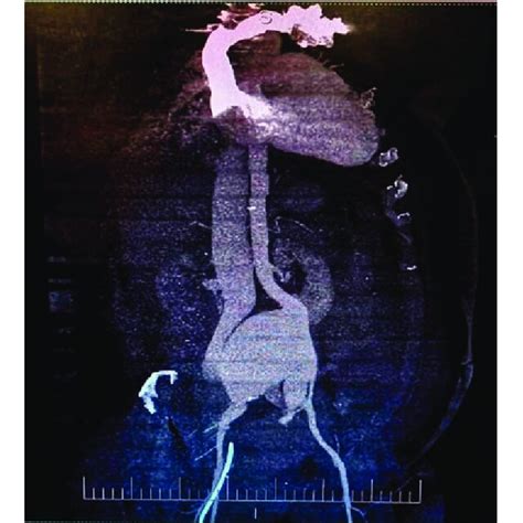 Ct Aortogram Showing Large Infrarenal Abdominal Aortic Aneurysm