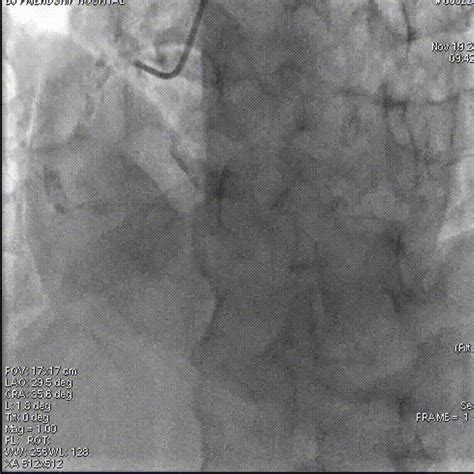 病例荟萃第三十三期 周力：一支右冠脉，三次上台来相见 严道医声网