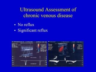 Ultrasound Assessment Of Chronic Venous Disease Ppt