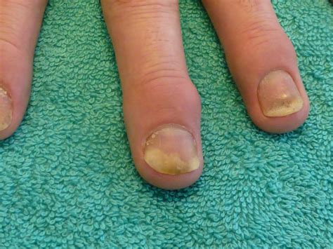 Psoriasisarthritis Doccheck Flexikon