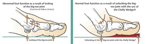 Principles Of First Ray Surgery Hallux Rigidus Limitus Flashcards