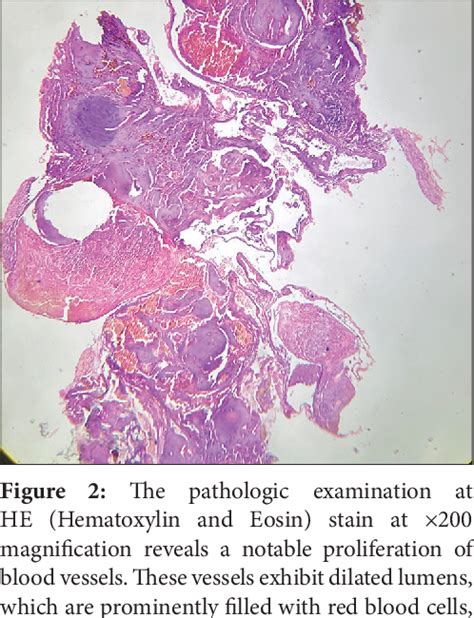Figure 2 From Intradural Extramedullary Cervical Cavernoma Semantic