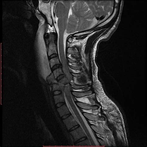 Radiopaedia Case Flexion Teardrop Fracture Dislocation Of The Cervical