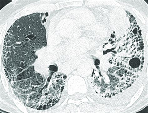 Lung Cancer And Ct Pattern Typical For Uip Axial Ct Image At The Level
