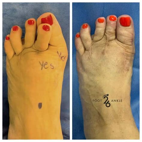 Hammertoe Surgery Cross Over Toe 26 Foot And Ankle