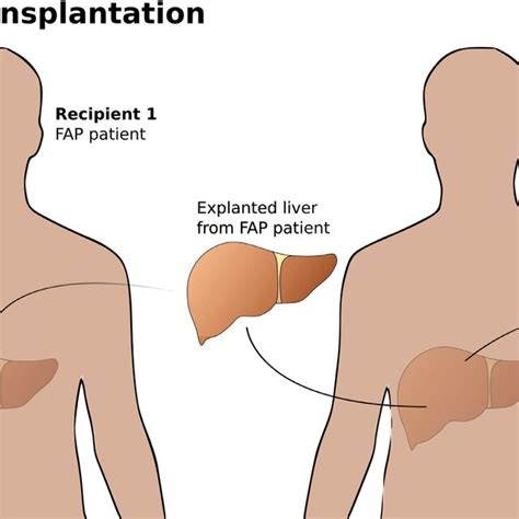 Survival Rate Of Different Patient Groups After Liver Transplantation