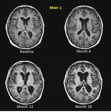 Multiple Sclerosis Research Brain Atrophy The Ultimate Outcome In Ms