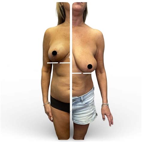 Breast Lift Surgery Tampa Natural Mastopexy By Dr Gargya