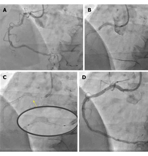 Longitudinal Deformation Of A Stent Implanted At The Ostium Of The