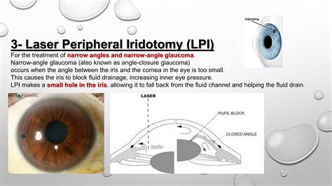 Laser Therapy In Glaucoma Pptx