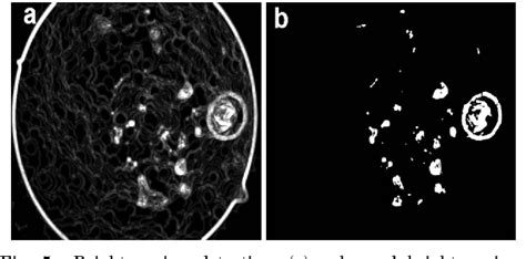 Figure 5 From Automated Detection Of Exudates In Colored Retinal Images
