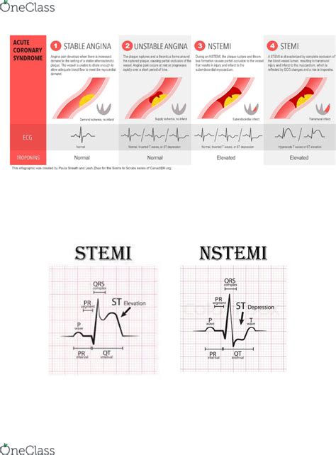Unstable Angina Ecg