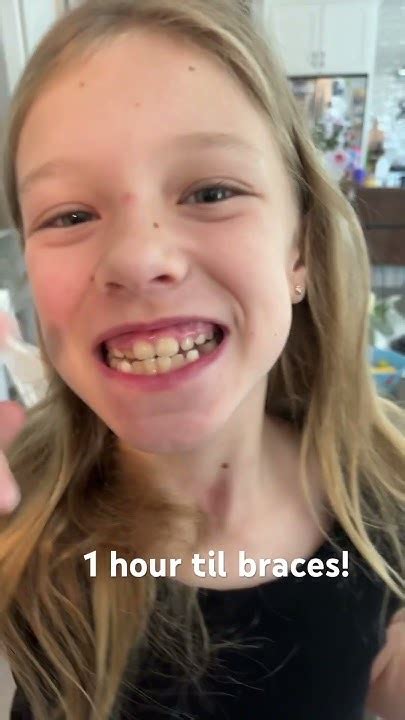 Getting Braces Youtube