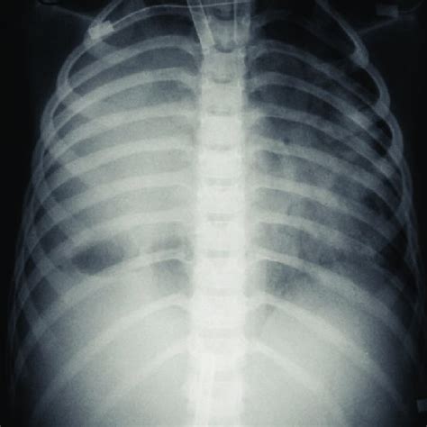 Chest X Ray Before Removal Of Ecmo Download Scientific Diagram