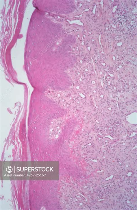 Histology Painfull Node At The Helix Ear Chondrodermatitis