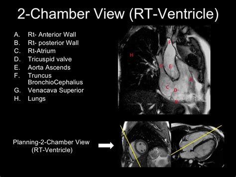 Mri Cardiac Anatomy