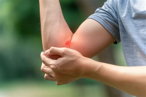 Tendinitis De Codo Síntomas Y Tratamiento Efectivo