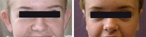 Plastic Surgery Before And After Photos Ear Surgery