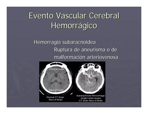 Evc Hemorragico Pdf