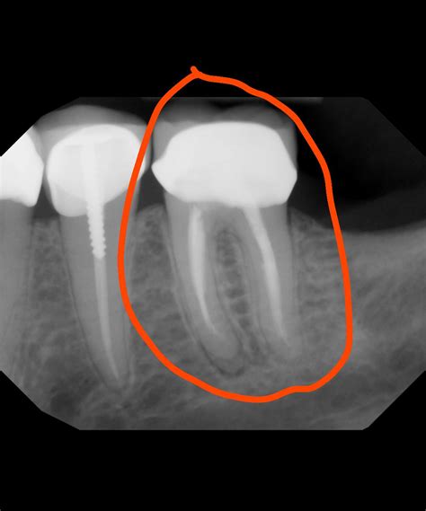 Abscess Tooth And Root Canal At Cameron Malone Blog