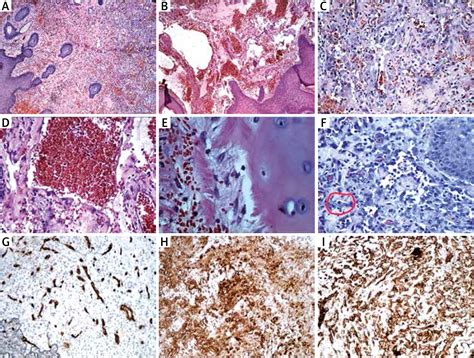 Large Primary Cutaneous Angiosarcoma Of The Nose Successfully Treated