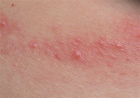 Contact Dermatitis Causes Types Symptoms And Prevention
