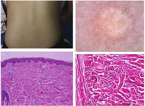 Dermoscopy Of Papular Elastorrhexis Chinese Medical Journal