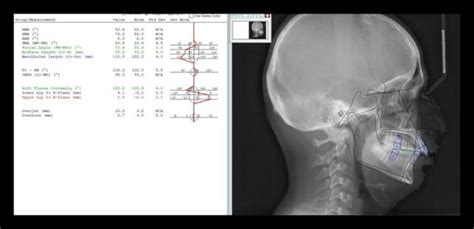 Cephalometric Analysis For Required Measurements At Study Groups