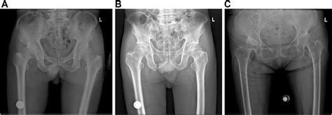 Risk Factors For Periprosthetic Femoral Fractures After Cementless