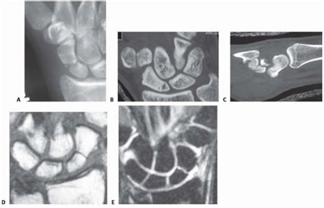 Open Reduction And Internal Fixation Of Scaphoid Fractures
