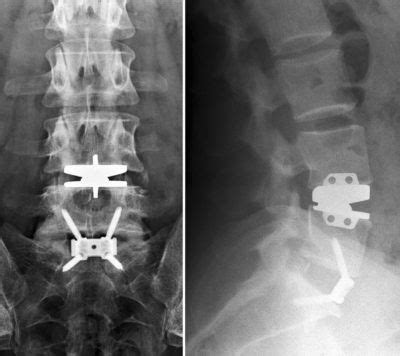 Alif And Total Disc Replacement Versus 2 Level Circumferential Fusion
