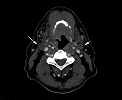 Computed Tomography Scan Of A Patient With An Hpv Oropharyngeal