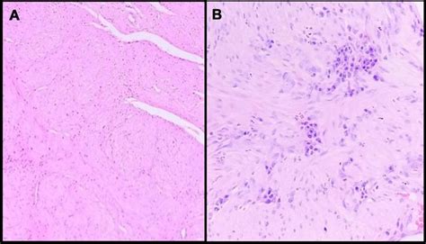 A Submitted Specimen Collected From The Urinary Bladder Revealed Masses