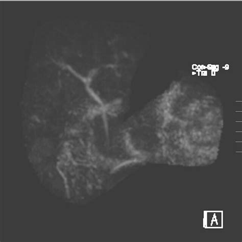 Mrcp Reconstructed 3d View Of The Biliary Tree Cystic Duct And