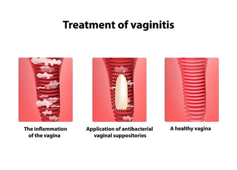 What Is The Treatment Of Vaginitis Diseasefix