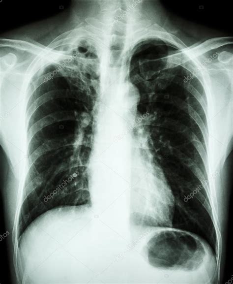 Cavidade De Tuberculose Pulmonar Raio X De Tórax Infiltração