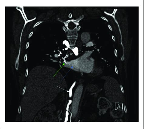 Coronal View Of Computed Tomography Angiogram Download Scientific Diagram