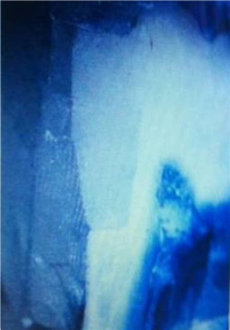 Occlusal Margin Of The Class Ii Box In The Enamel And Gingival Margin