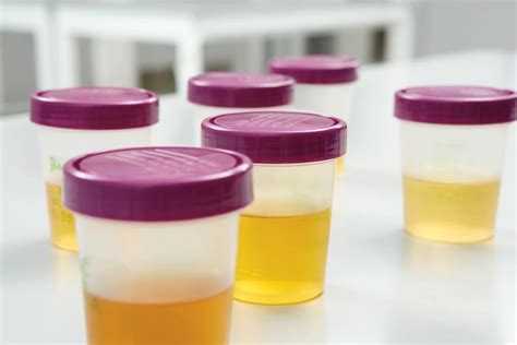 Specialty Urine Testing Siemens Healthineers