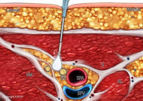 Cryoneurolysis Group Courses — Ultrasound Experts