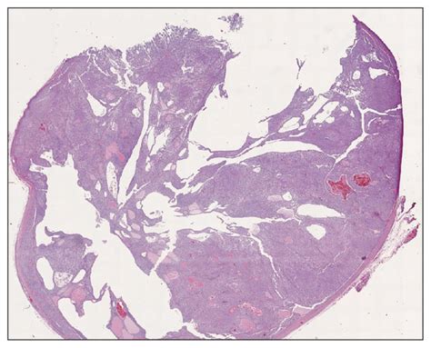 The Outcome For Feline Non Hypersecretory Thyroid Carcinoma After