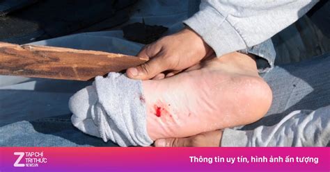 Biến Chứng Nguy Hiểm Của Bệnh Uốn Ván Znews Vn