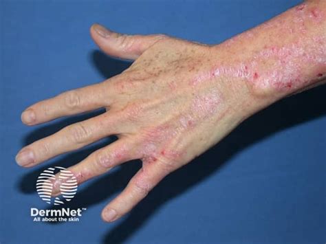 Inflammatory Linear Verrucous Epidermal Nevus Ilven Inflammatory