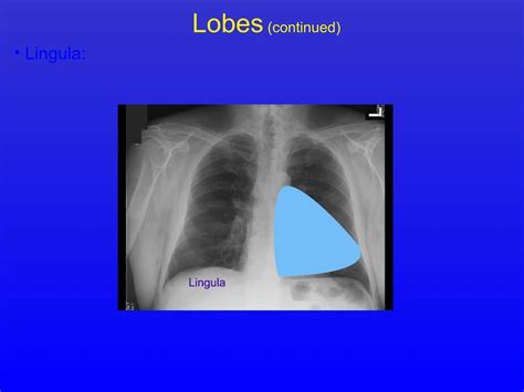 Reading The Chest X Ray Dr Schembri 723ppt